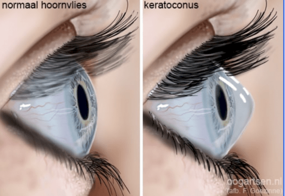 Sclera lenzen